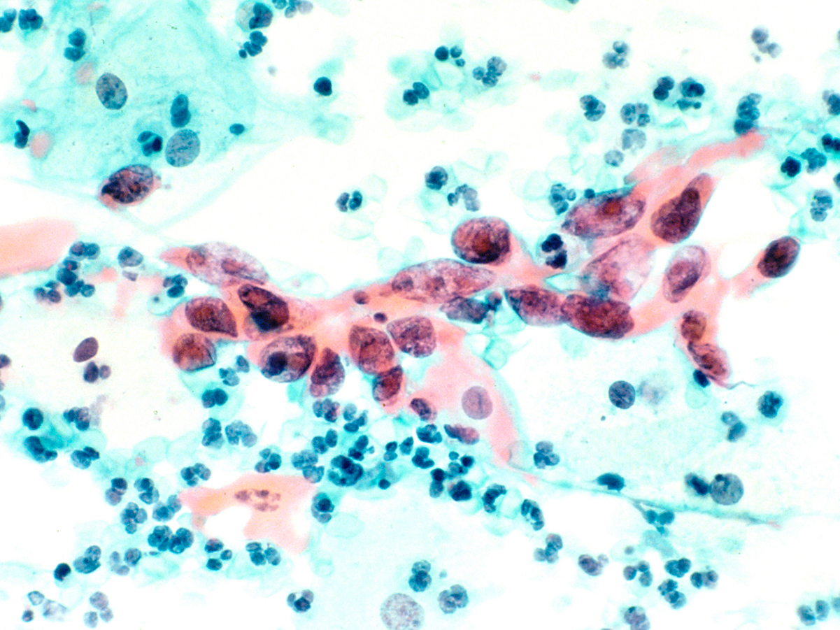 New trial compares open versus minimally invasive surgery for early ...