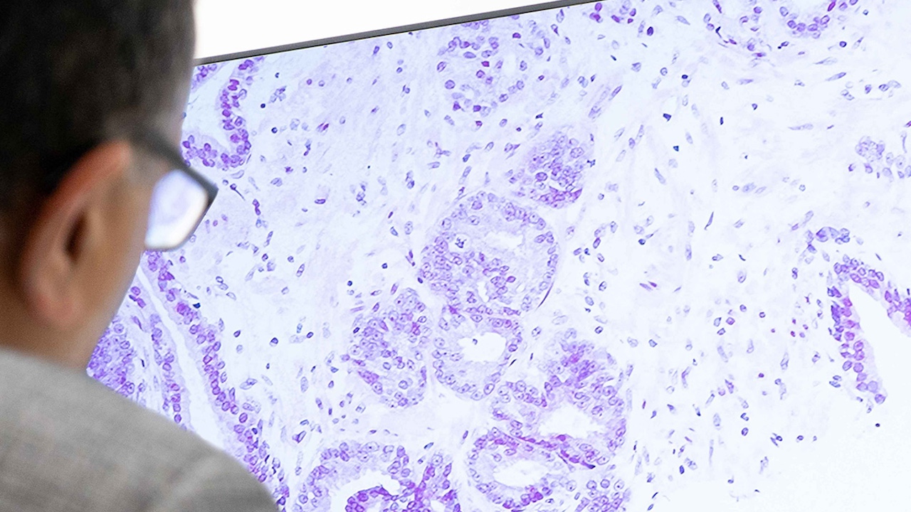 How AI innovation could improve colon cancer care