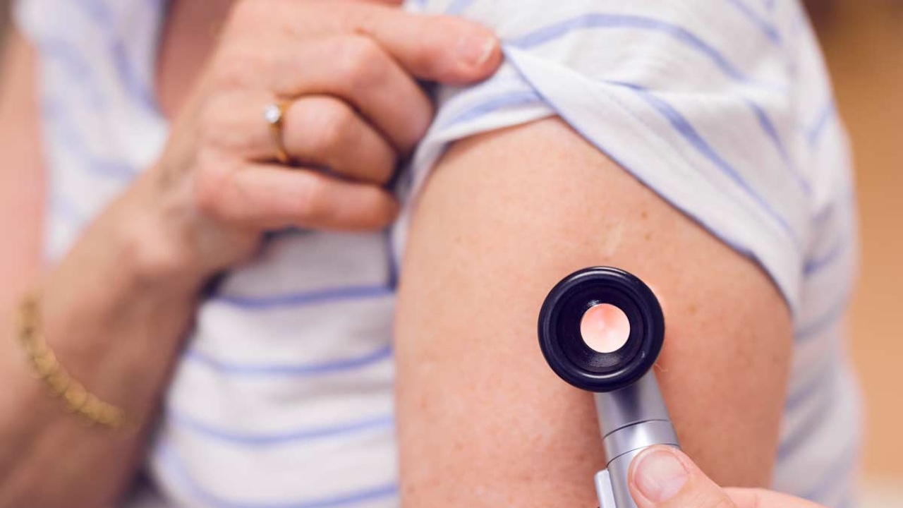Learn about melanoma prevention, screening and treatment